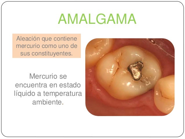 Qu Es Una Amalgama Dental Odontotecks