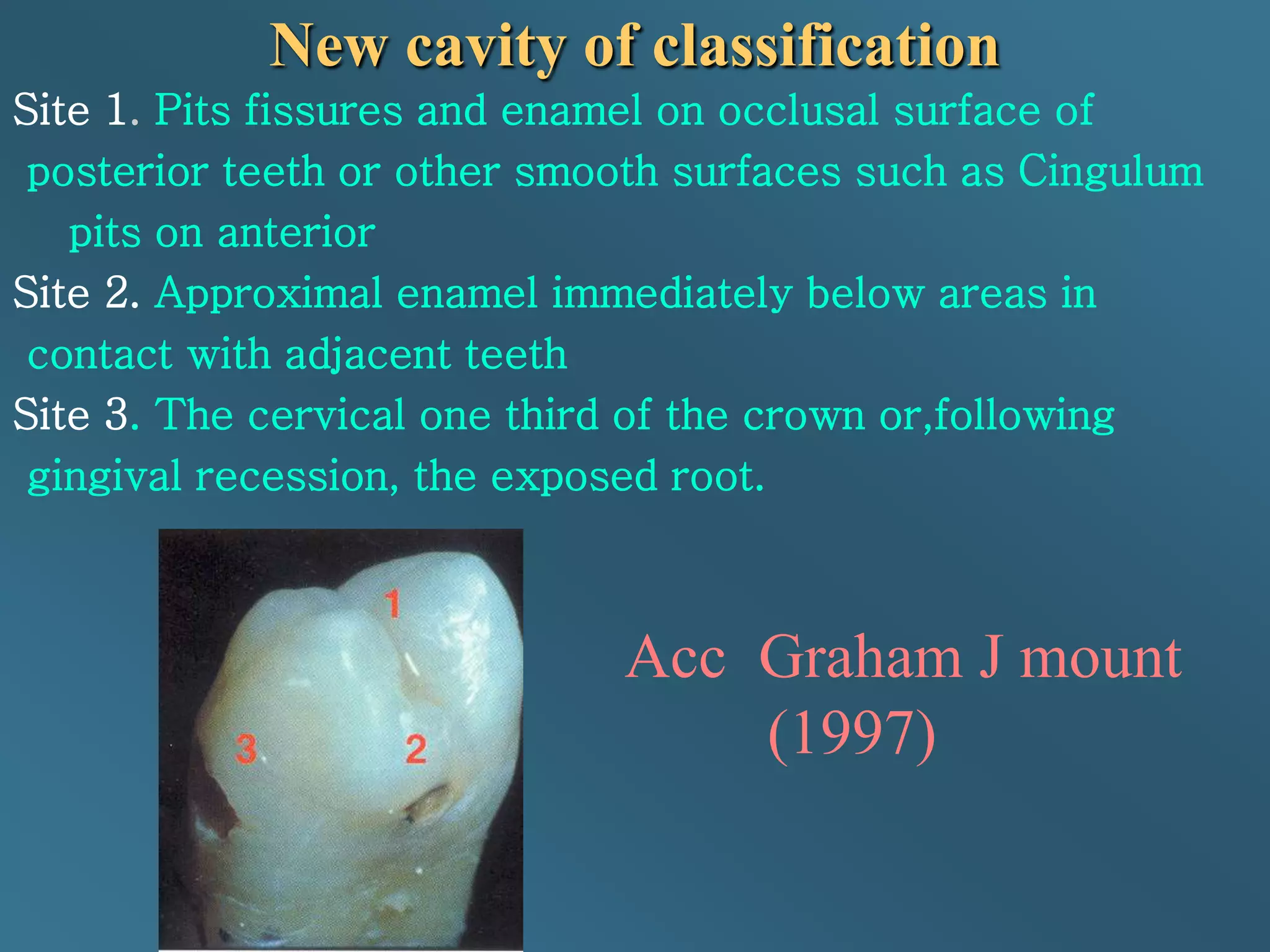 Amalgam cavity design | PPT