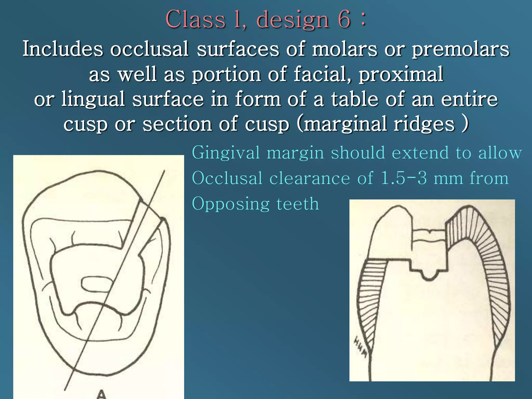 Amalgam cavity design | PPT