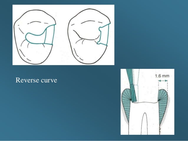 Amalgam cavity design