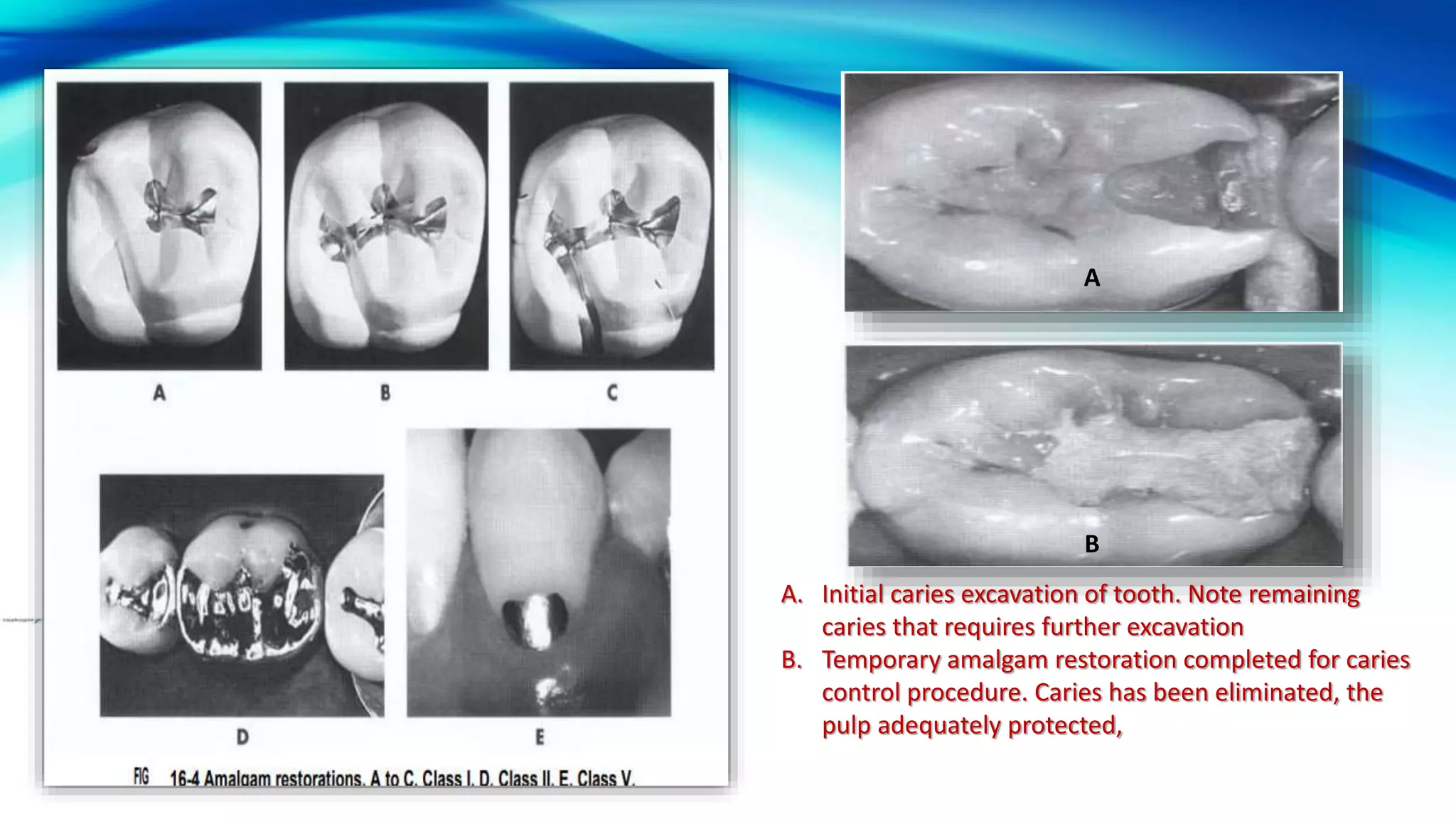 AMALGAM CAVITY PREPARATION | PPTX