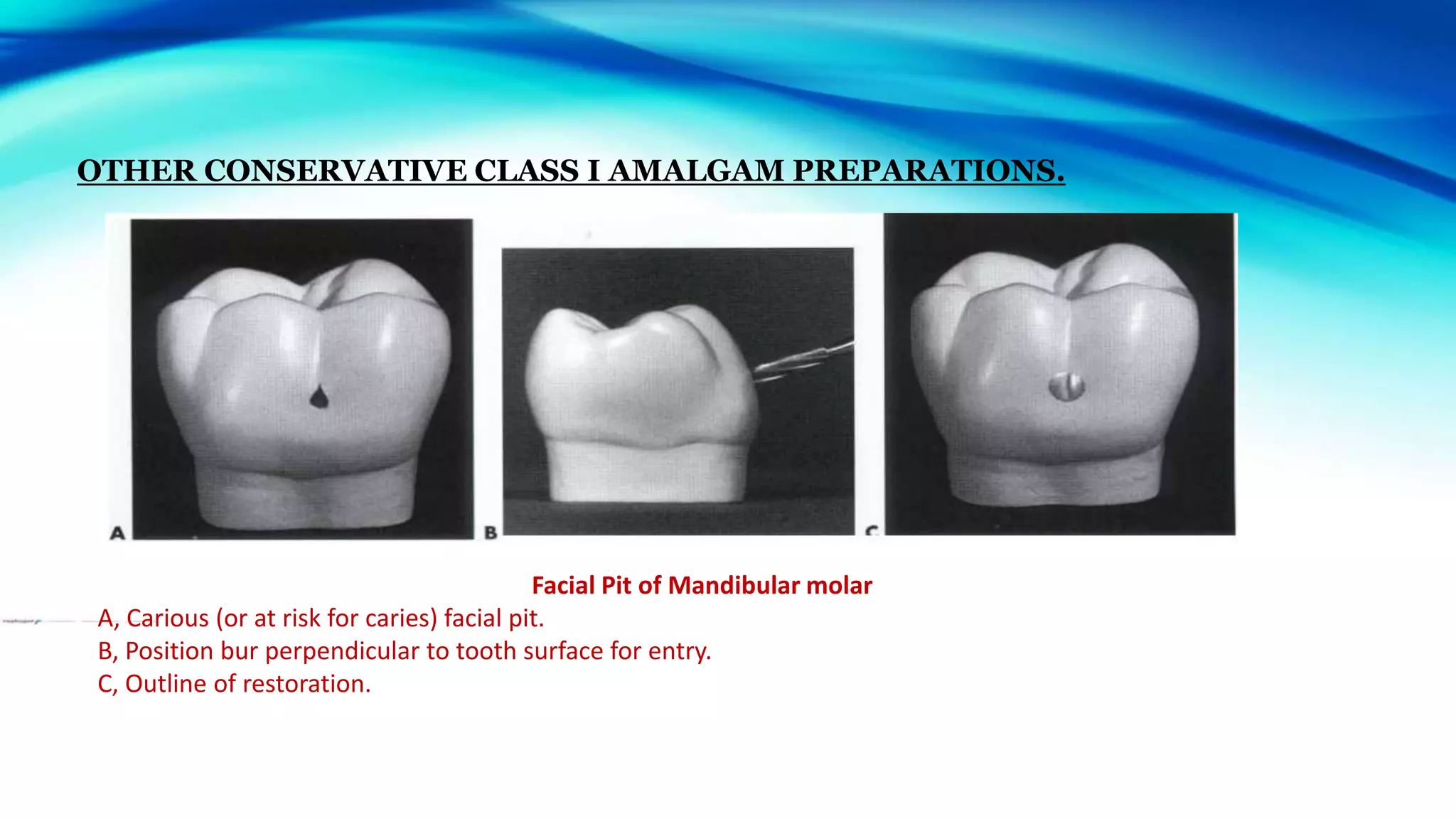 AMALGAM CAVITY PREPARATION | PPTX
