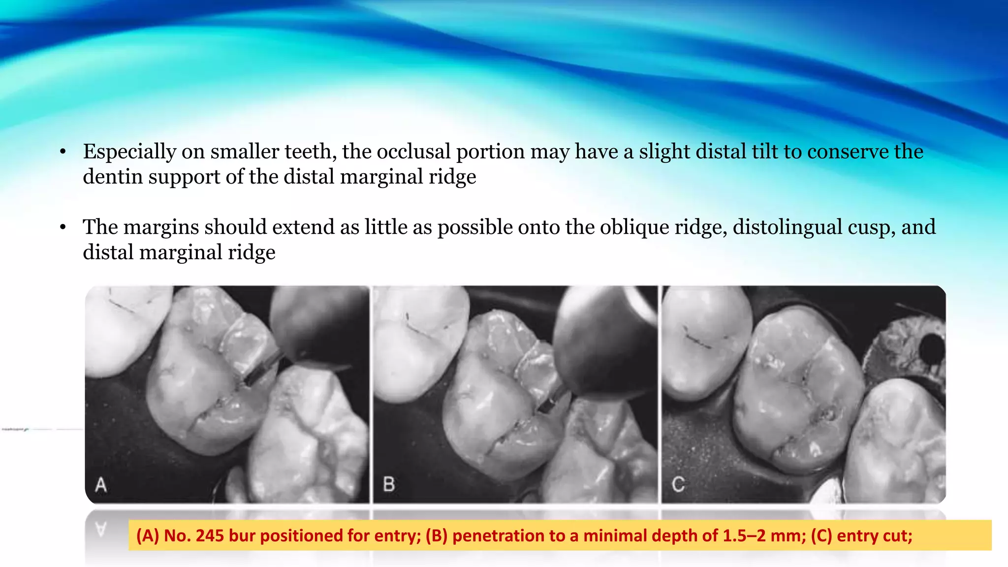 AMALGAM CAVITY PREPARATION | PPTX