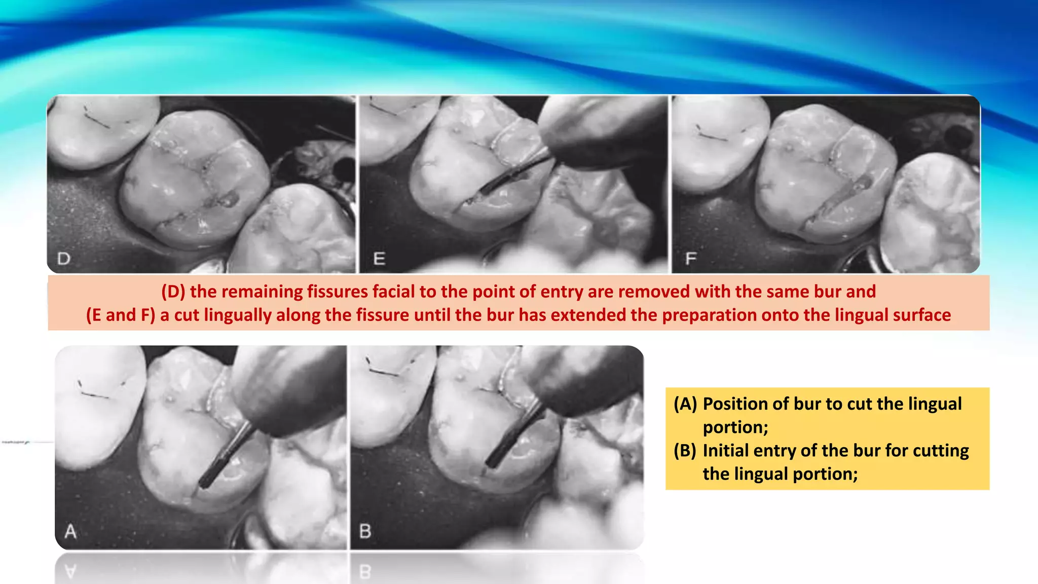 AMALGAM CAVITY PREPARATION | PPTX
