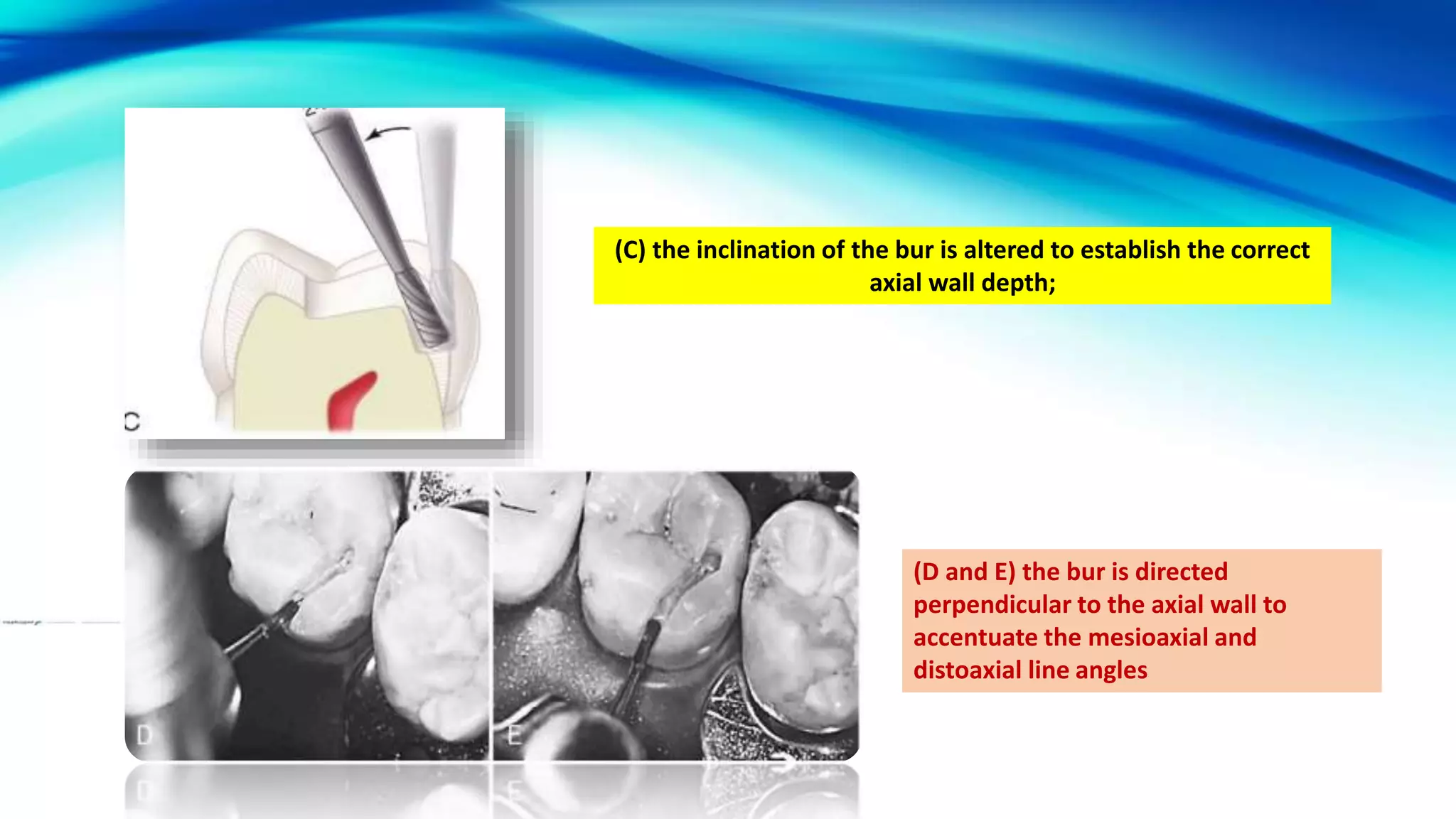 AMALGAM CAVITY PREPARATION | PPTX