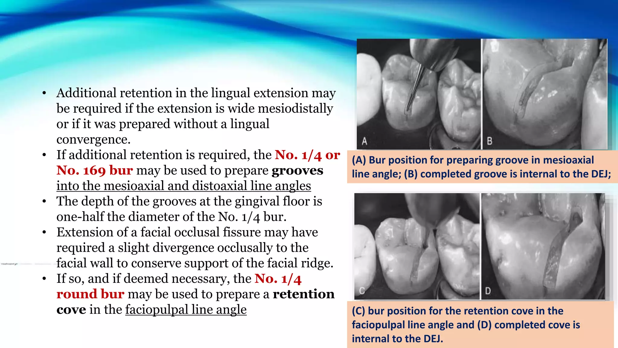 AMALGAM CAVITY PREPARATION | PPTX