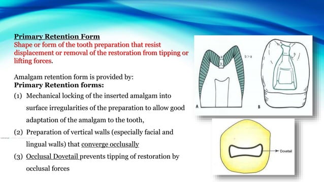 AMALGAM CAVITY PREPARATION | PPTX