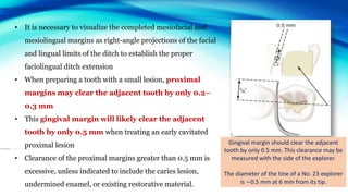 AMALGAM CAVITY PREPARATION | PPTX