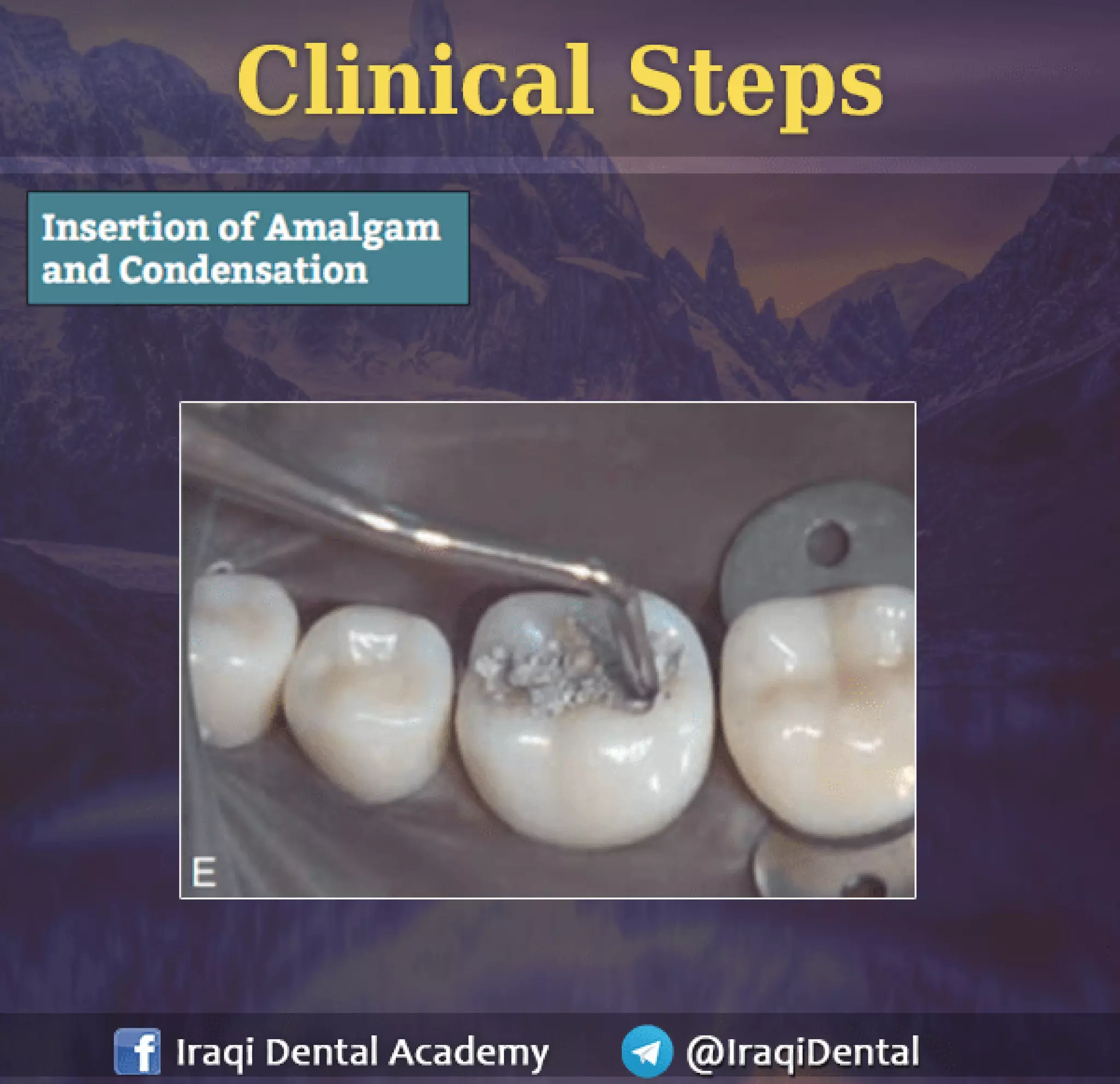 Amalgam Class I Restoration Explained | PDF
