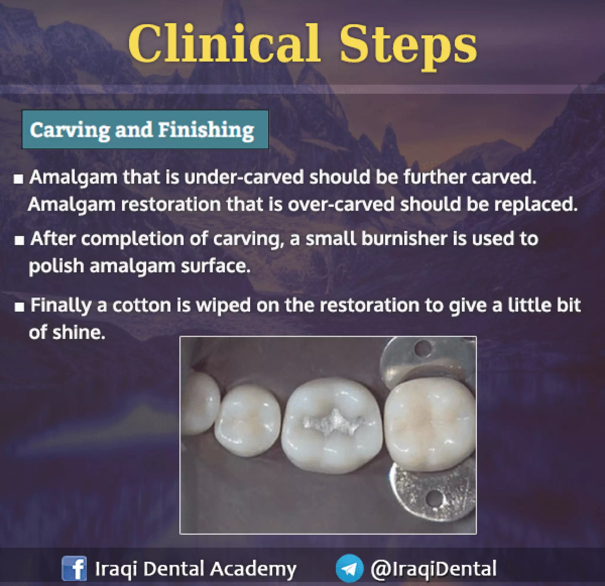 Amalgam Class I Restoration Explained | PDF