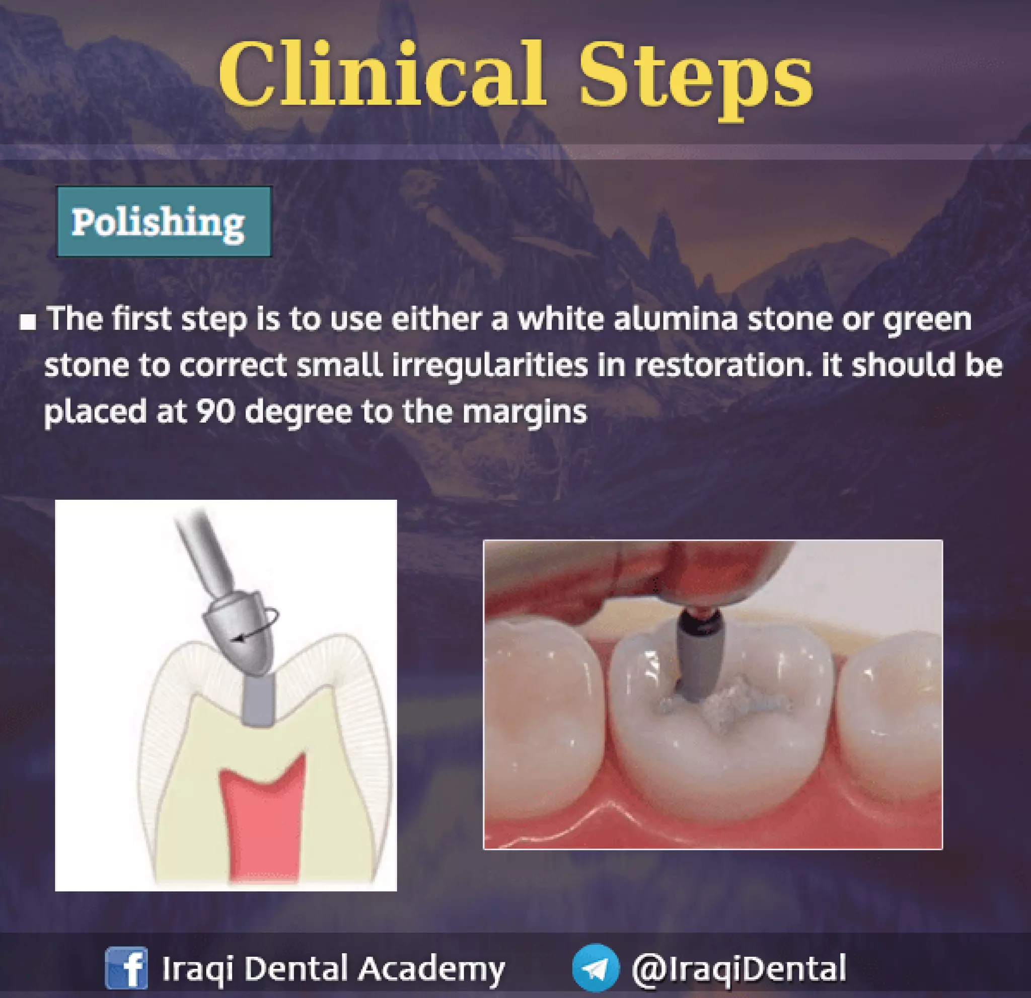 Amalgam Class I Restoration Explained | PDF
