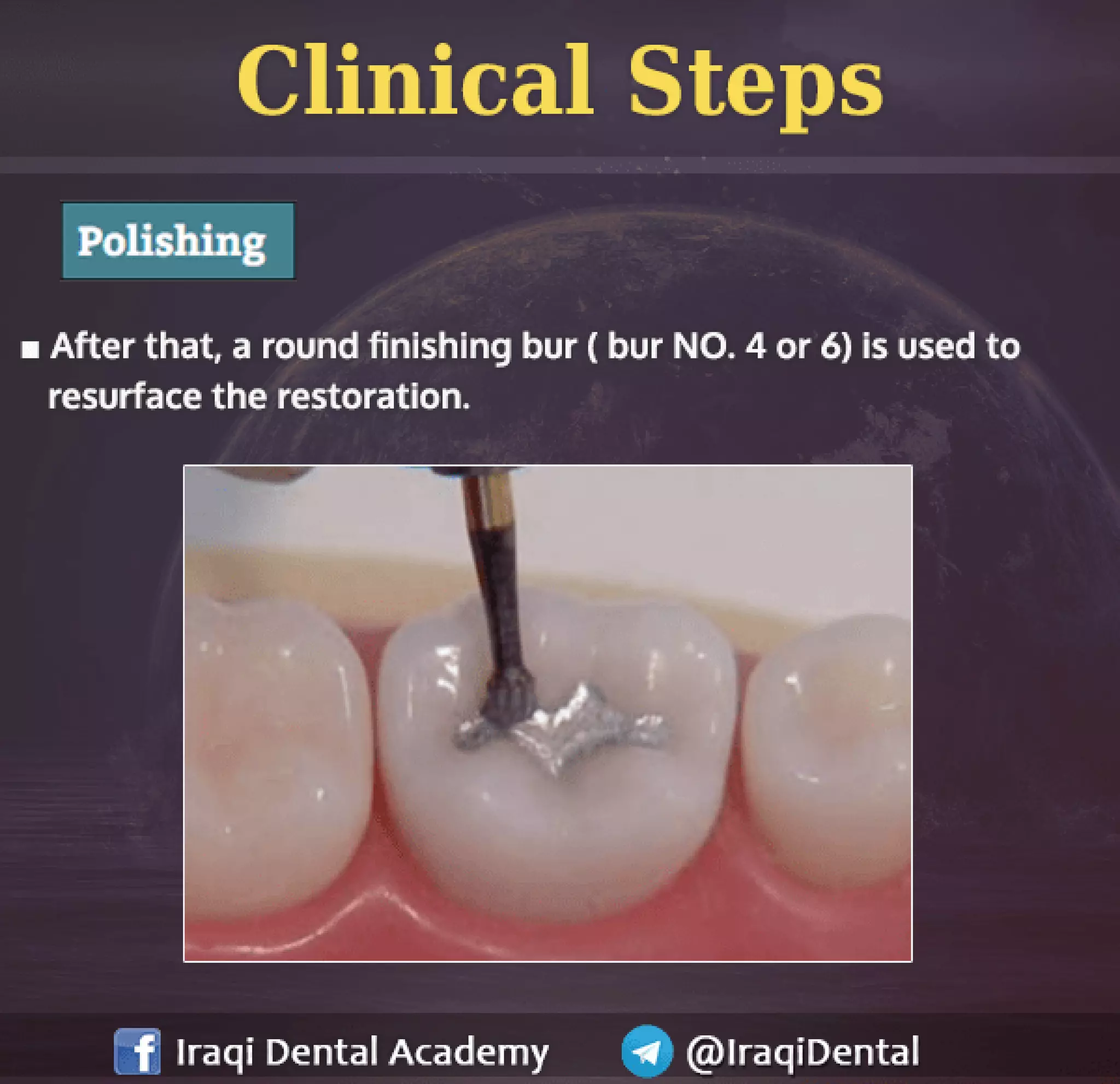 Amalgam Class I Restoration Explained | PDF