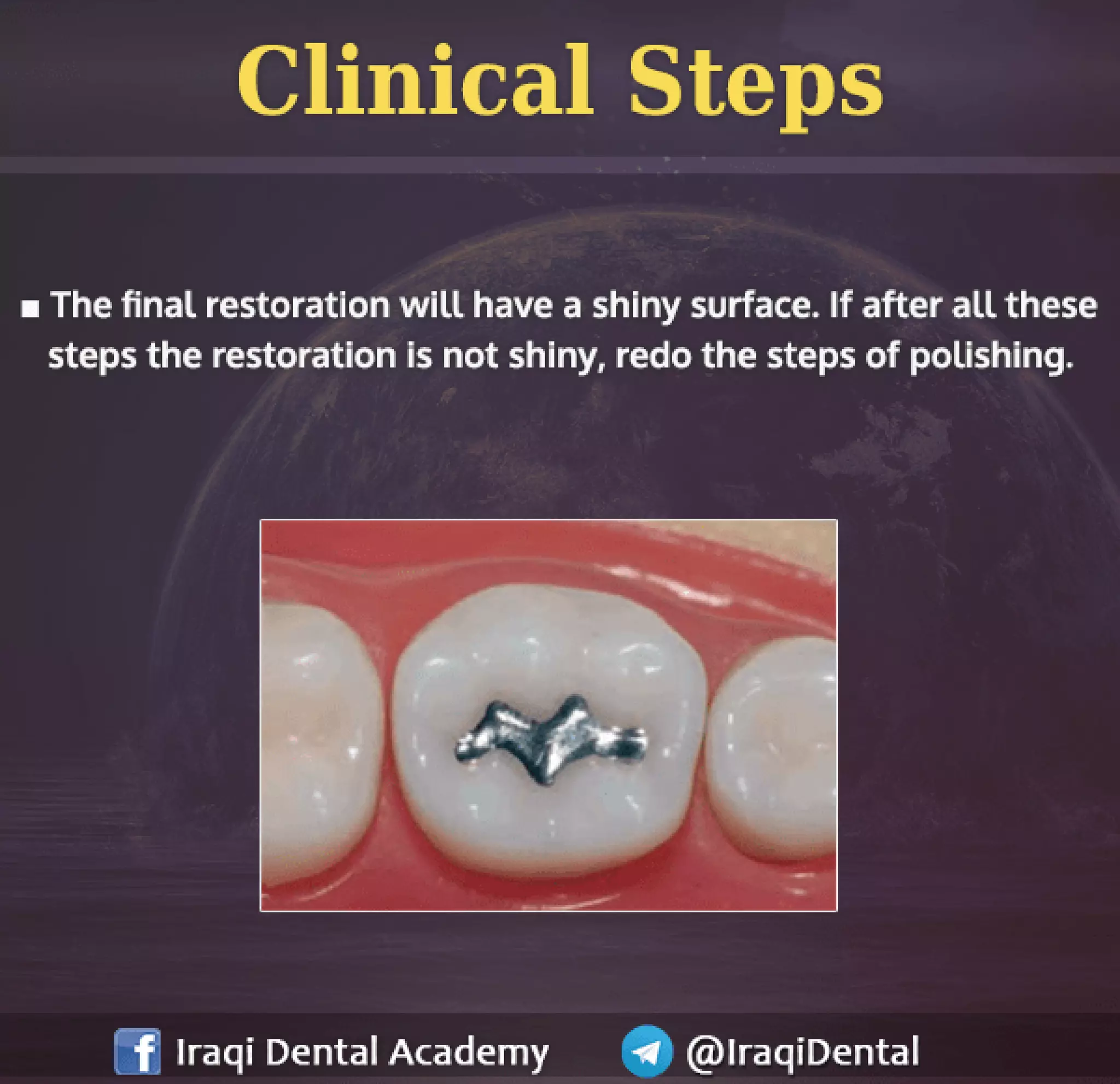 Amalgam Class I Restoration Explained | PDF