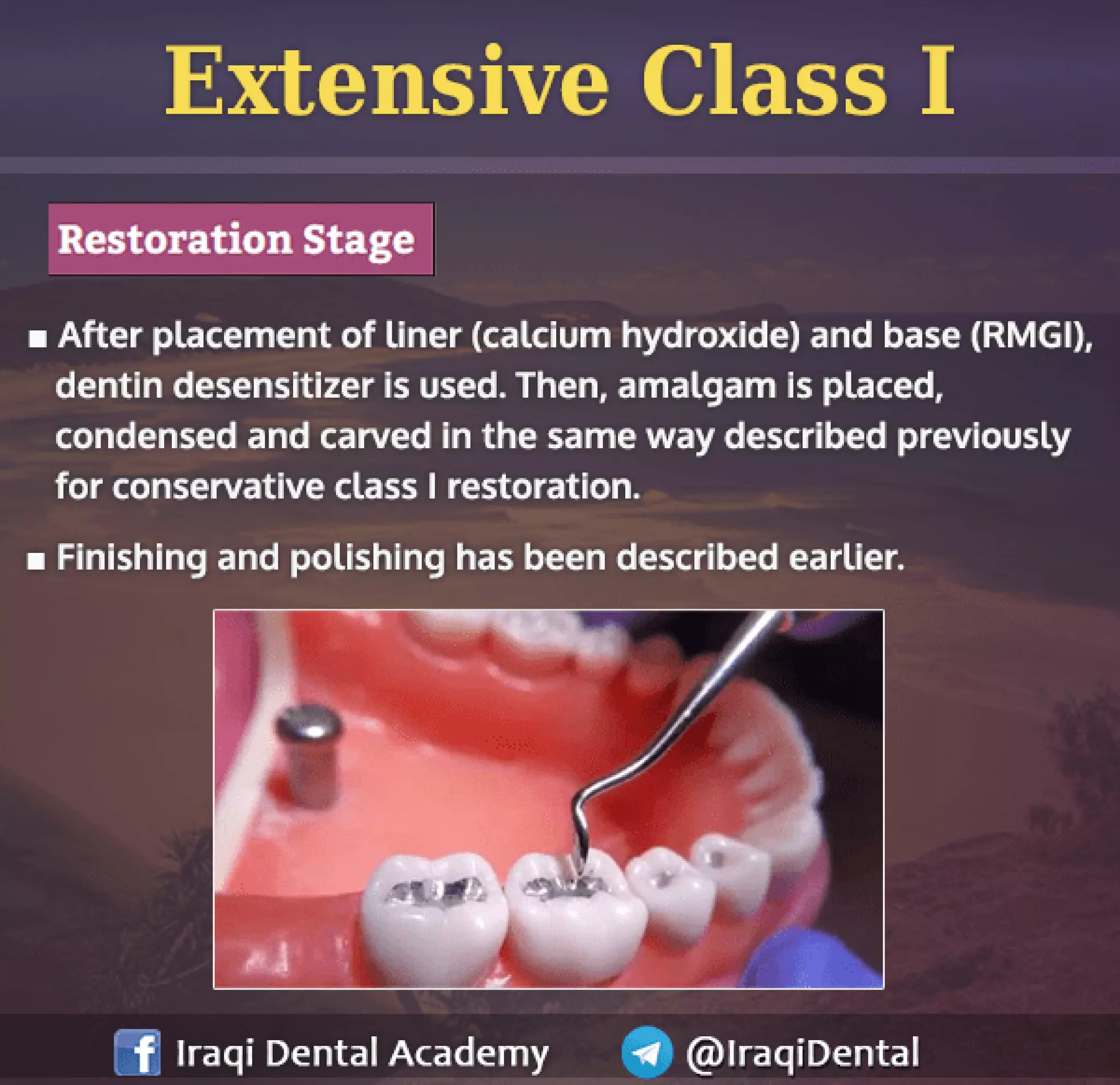 Amalgam Class I Restoration Explained | PDF