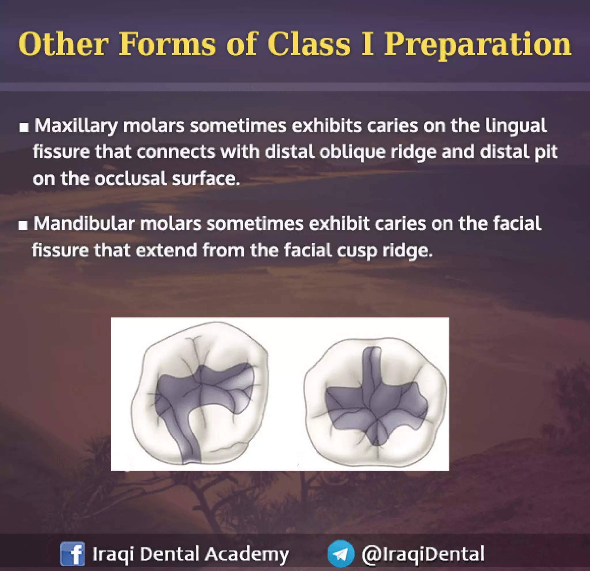 Amalgam Class I Restoration Explained | PDF