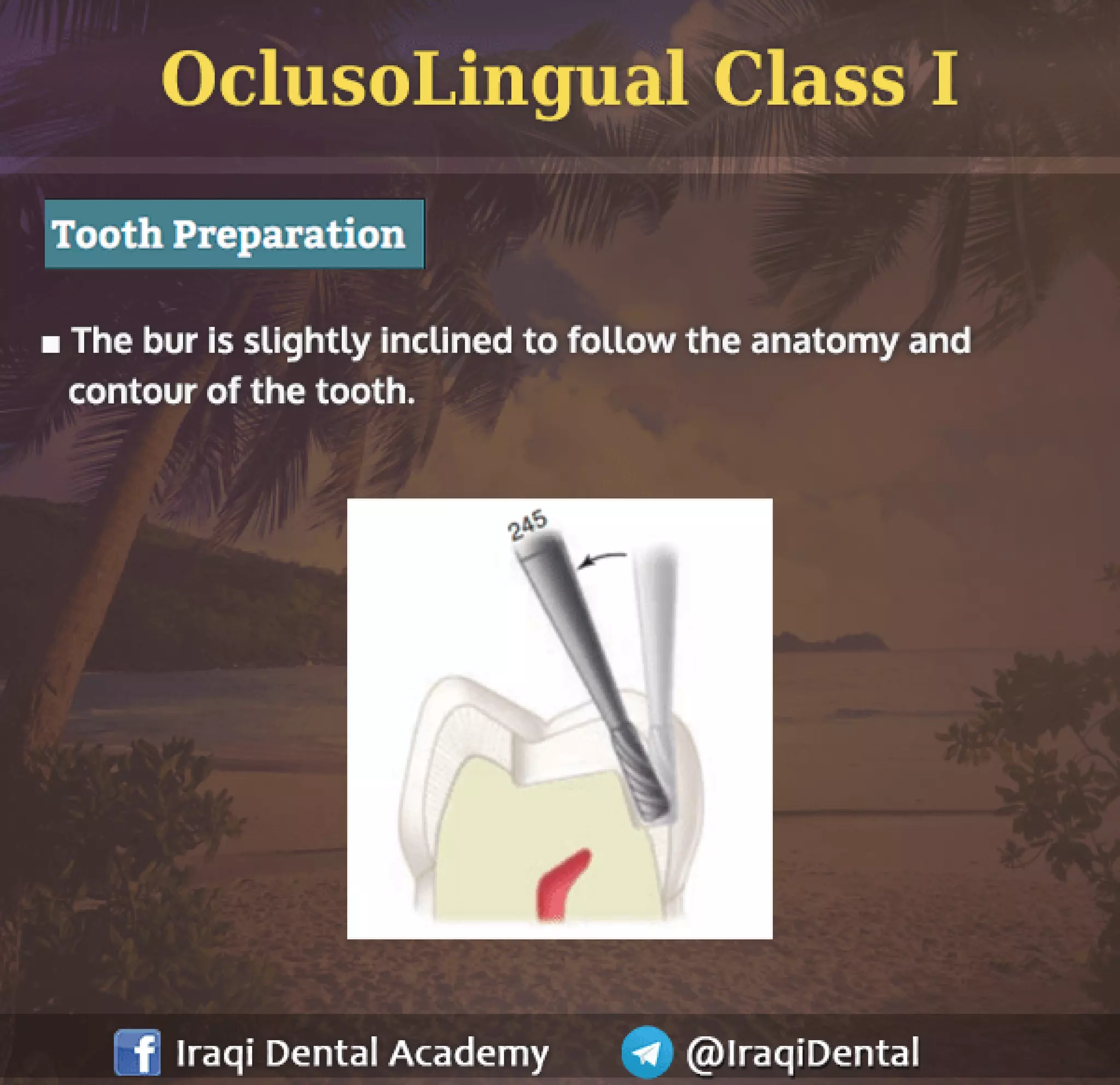 Amalgam Class I Restoration Explained | PDF