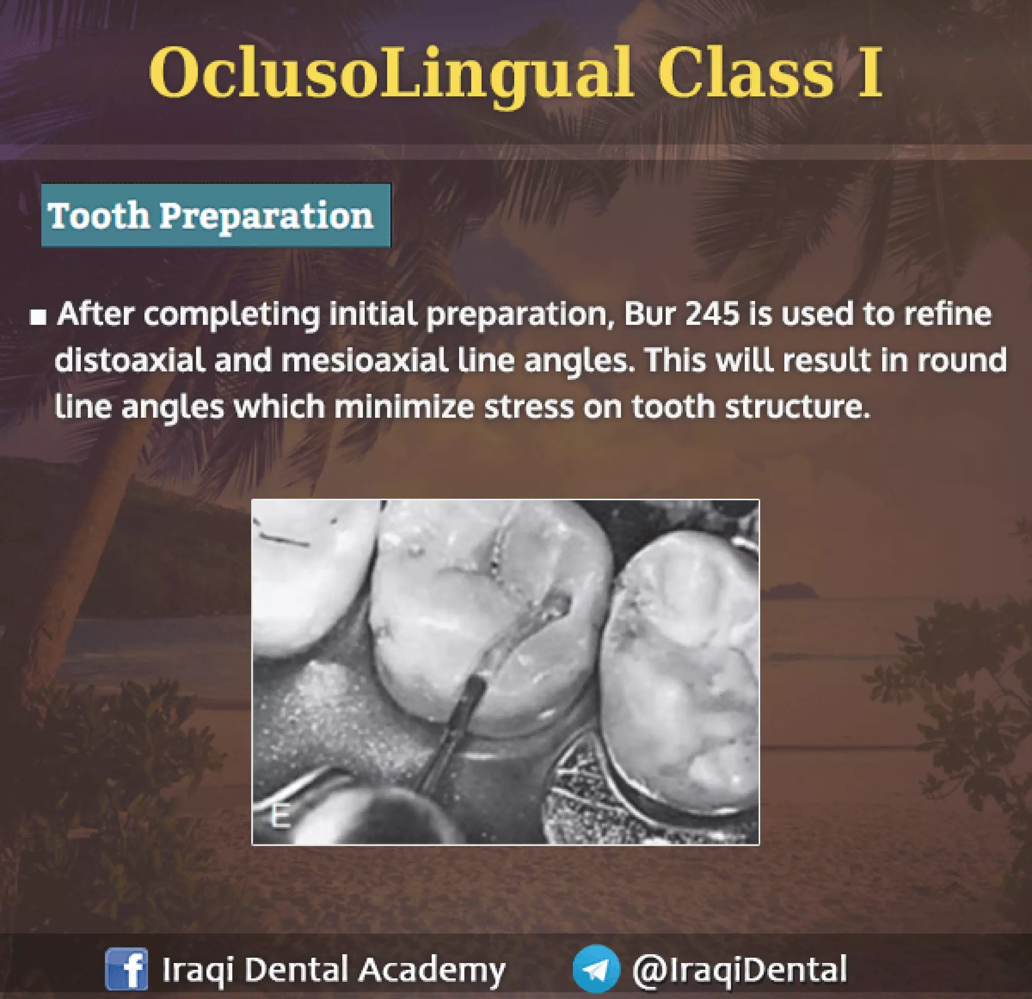 Amalgam Class I Restoration Explained | PDF