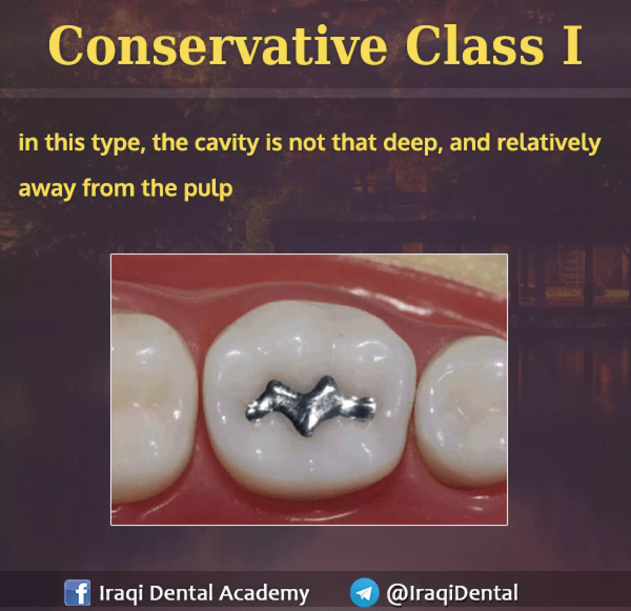 Amalgam Class I Restoration Explained | PDF