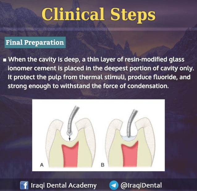Amalgam Class I Restoration Explained | PDF