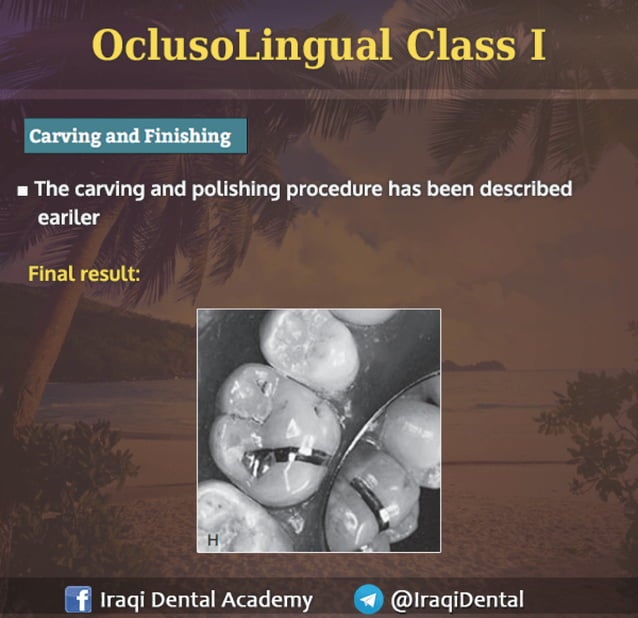 Amalgam Class I Restoration Explained | PPT