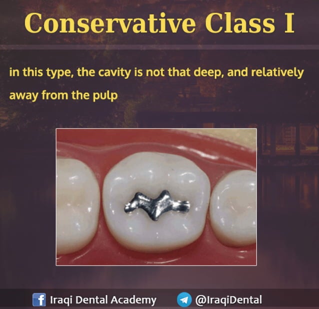 Amalgam Class I Restoration Explained | PDF