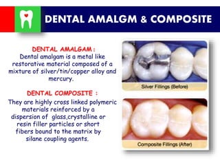 Amalgam fillings vs composite online