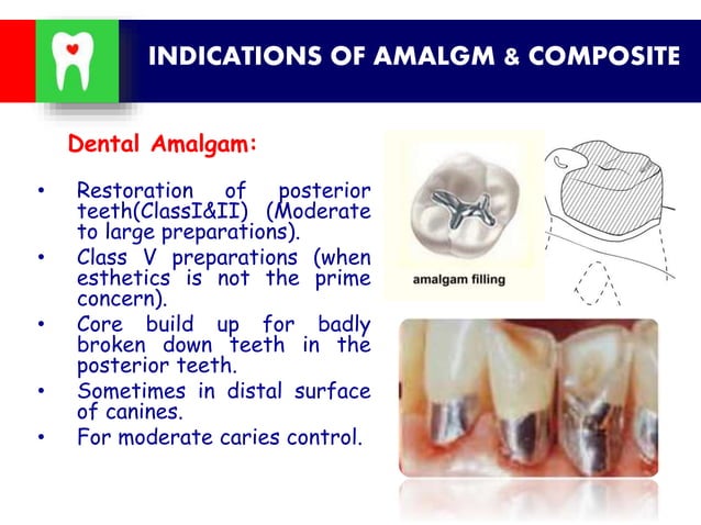 Amalgam &composite | PPTX