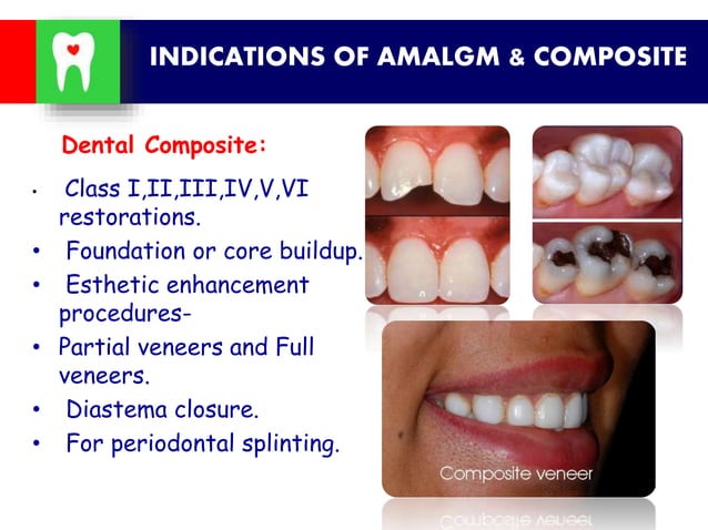 Amalgam &composite | PPTX
