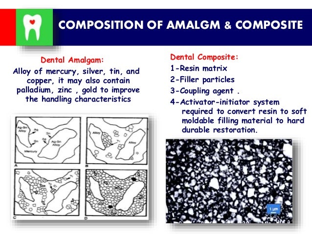 Amalgam &composite