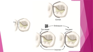 Amalgam_filling_restoration_•######.pptx