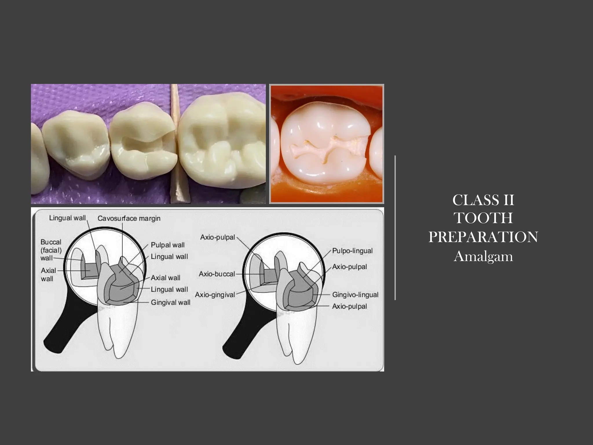 Amalgam restoration as material in dentistry | PDF