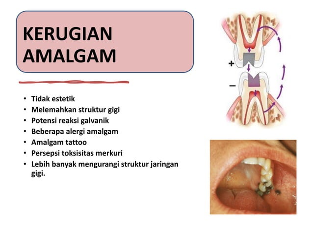 Amalgam restoration as material in dentistry | PDF