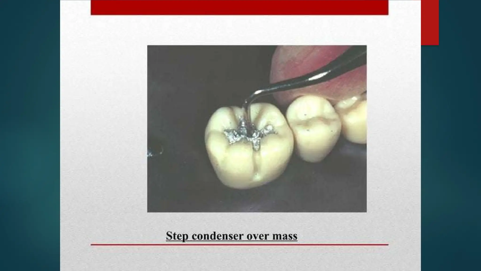 Dental Restoration Materials (Amalgam).pptx