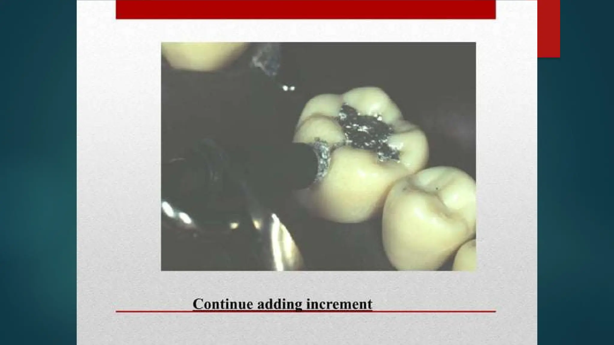 Dental Restoration Materials (Amalgam).pptx