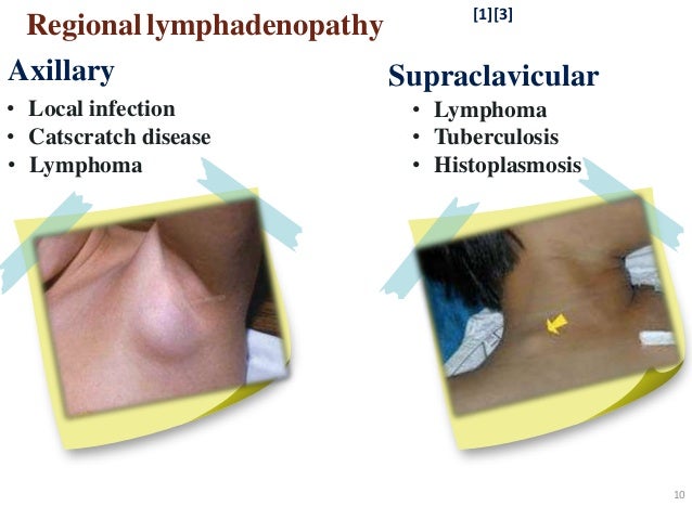 lymphadenopathy