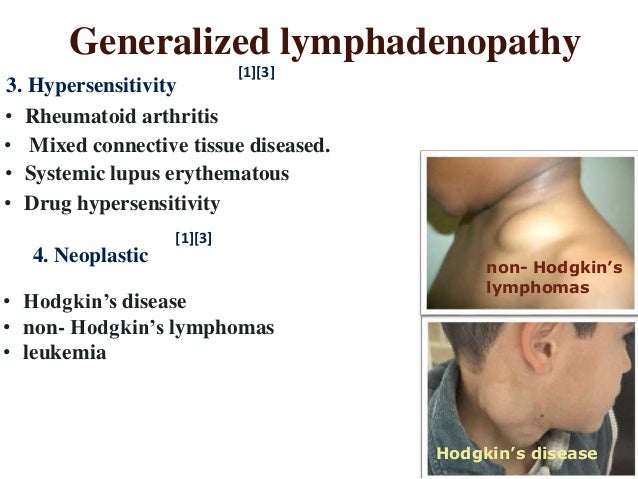 lymphadenopathy