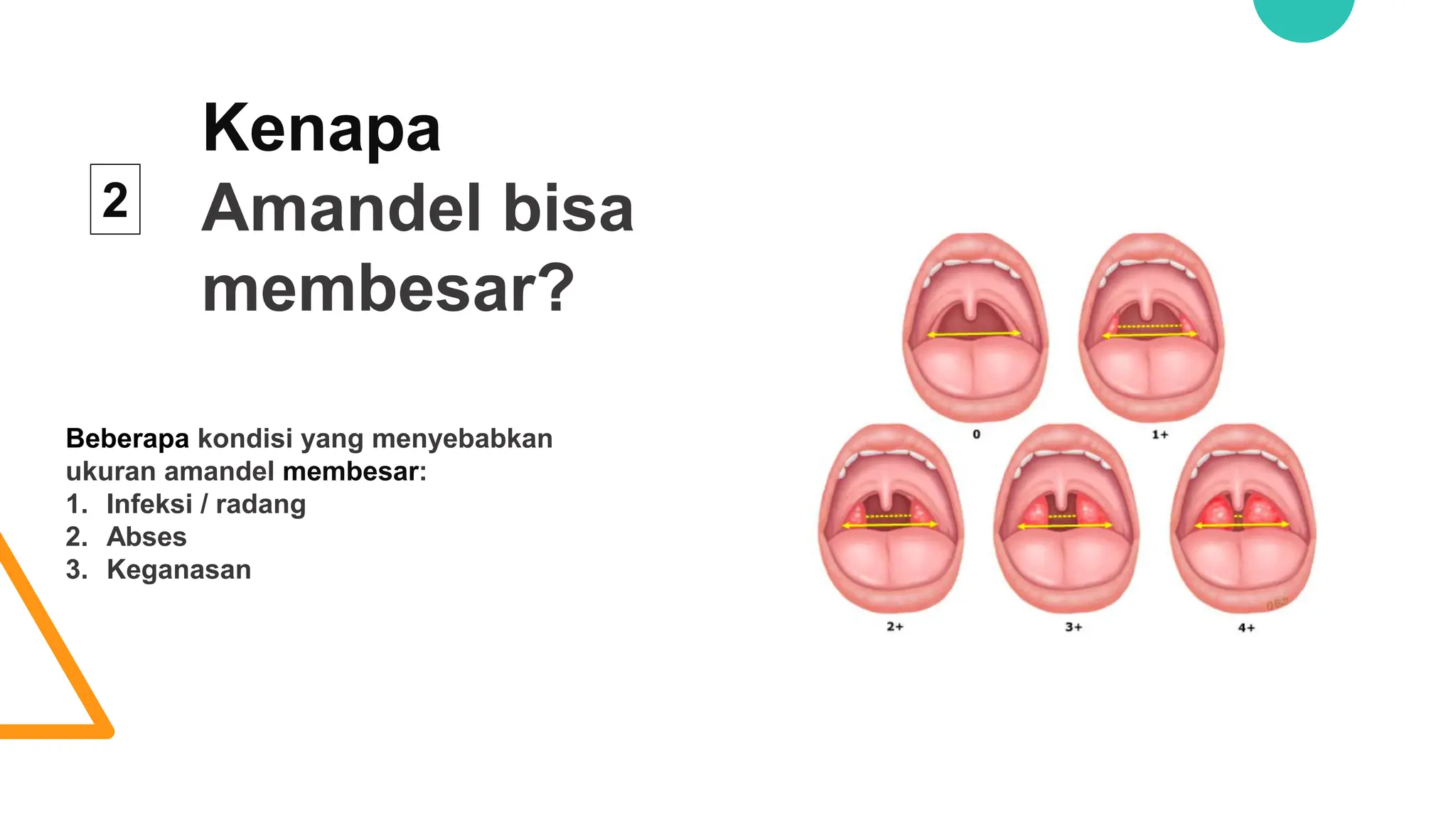 Amandel pada Anak, apakah harus selalu dioperasi.pptx