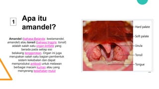 Amandel pada Anak, apakah harus selalu dioperasi.pptx