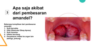 Amandel pada Anak, apakah harus selalu dioperasi.pptx