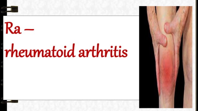 Amavata by Dr.Swatika Sharma | PPTX