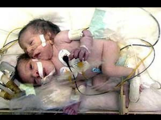Amazing Two Headed Babies | PPS