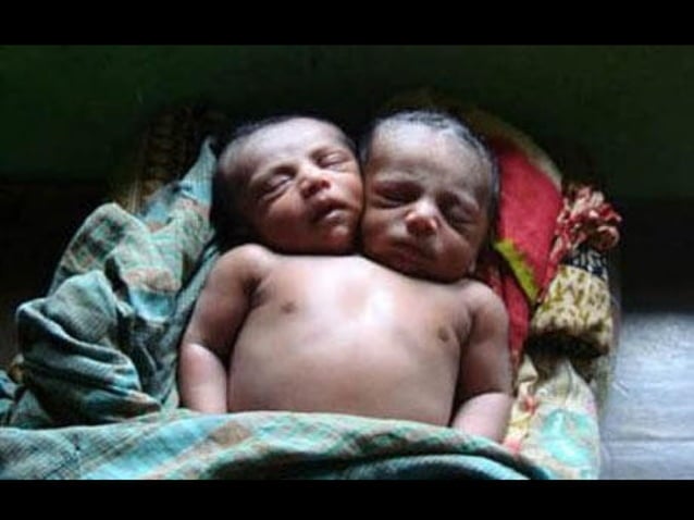 Amazing Two Headed Babies | PPS