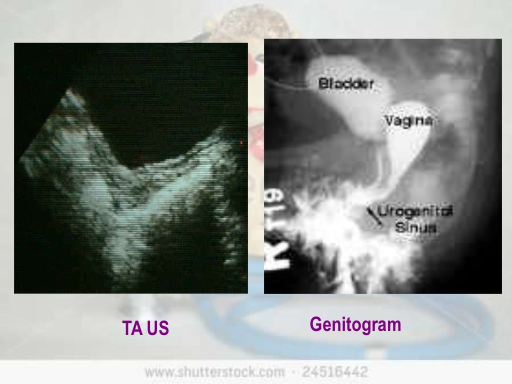 Ambiguous genitalia .....