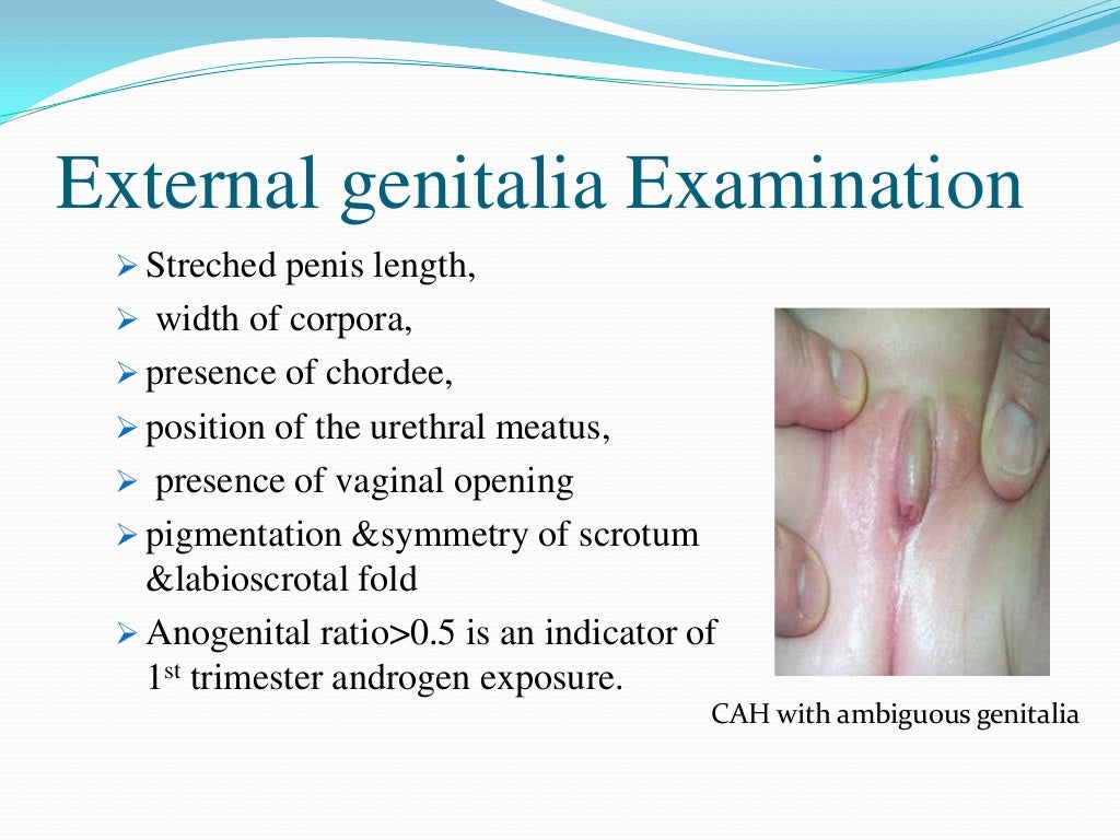 Ambiguousgenitalia ppt