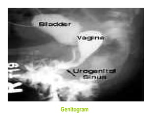 Ambiguous genitalia presentation | PPT