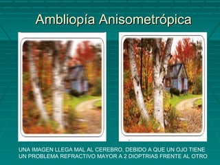 Ambliopia concepto diagnostico_tto | PPS