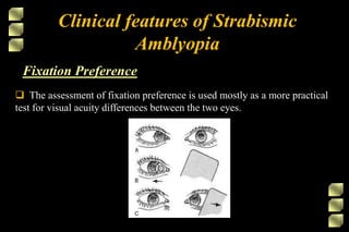 Amblioppia and it's management | PPTX