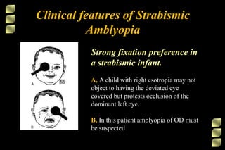 Amblioppia and it's management | PPTX