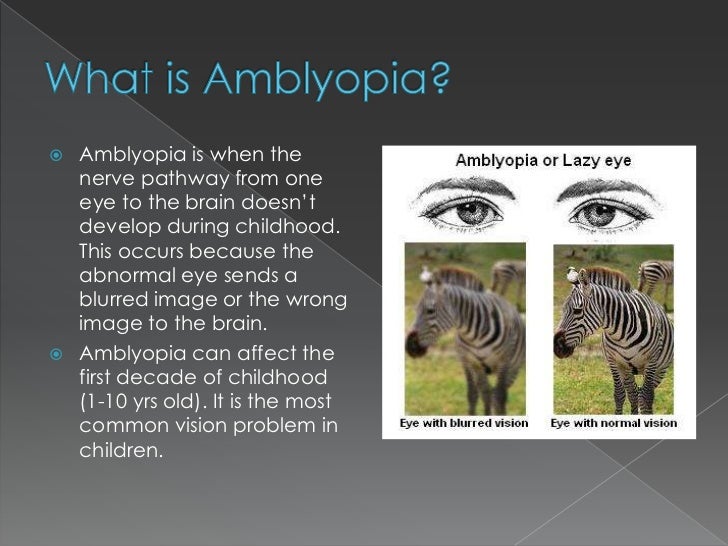 Amblyopia