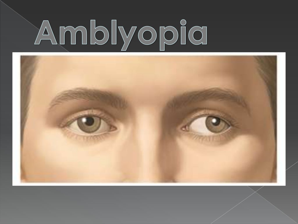 Amblyopia